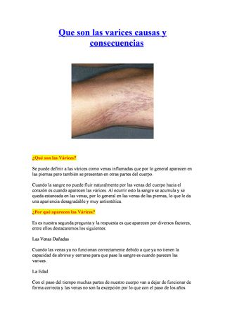 Que Son Las Varices Causas y Consecuencias